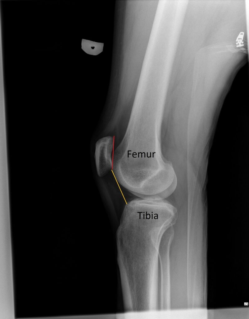 Patella Tendon Rupture and Repair with Augmentation and Suspensory ...