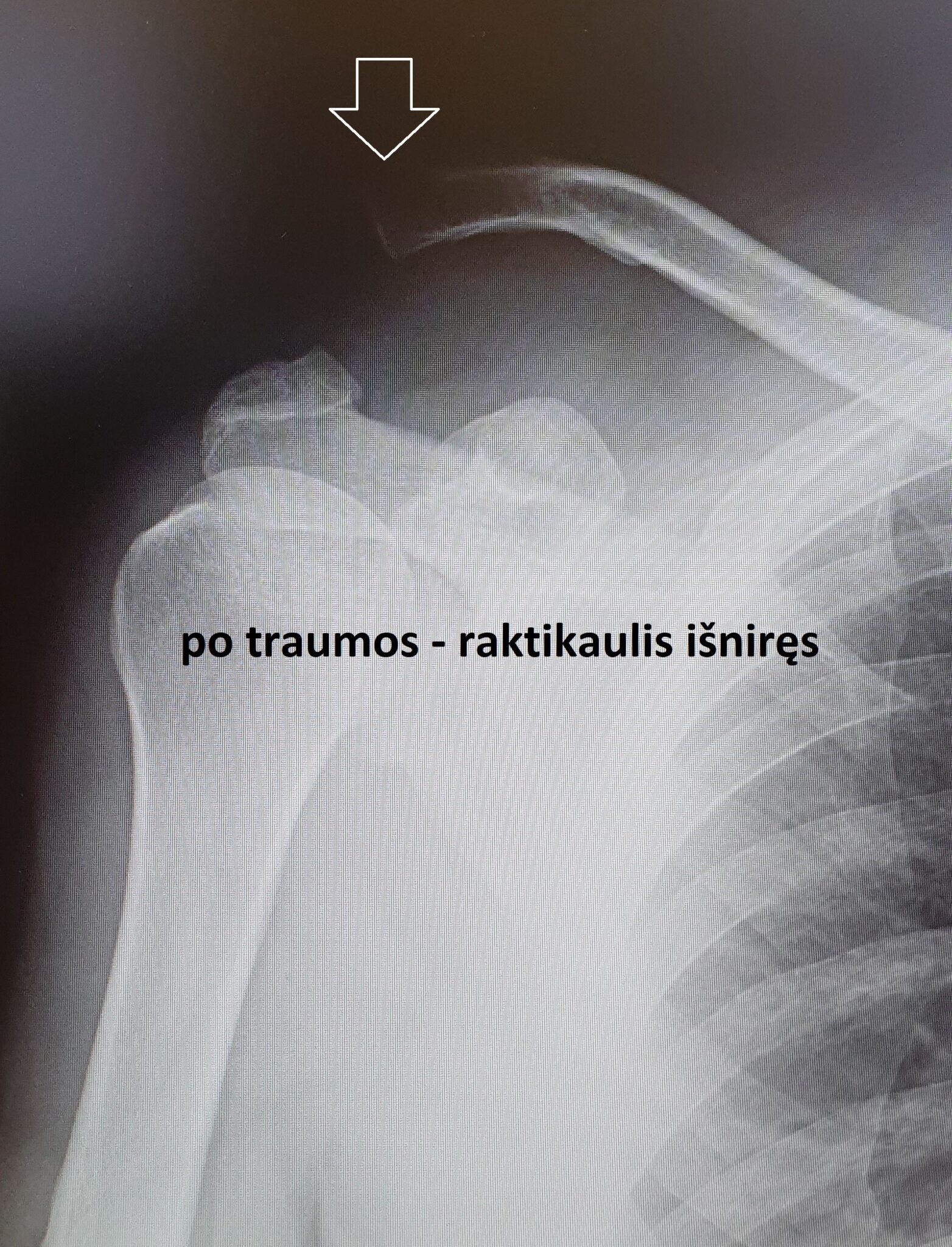 Išniro raktikaulis, fiksacija 4 sagų sistema - RimtautasGudas.lt
